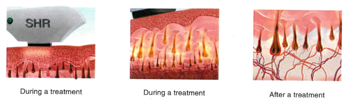 What is SHR Hair Removal? | Skin Solutions NZ